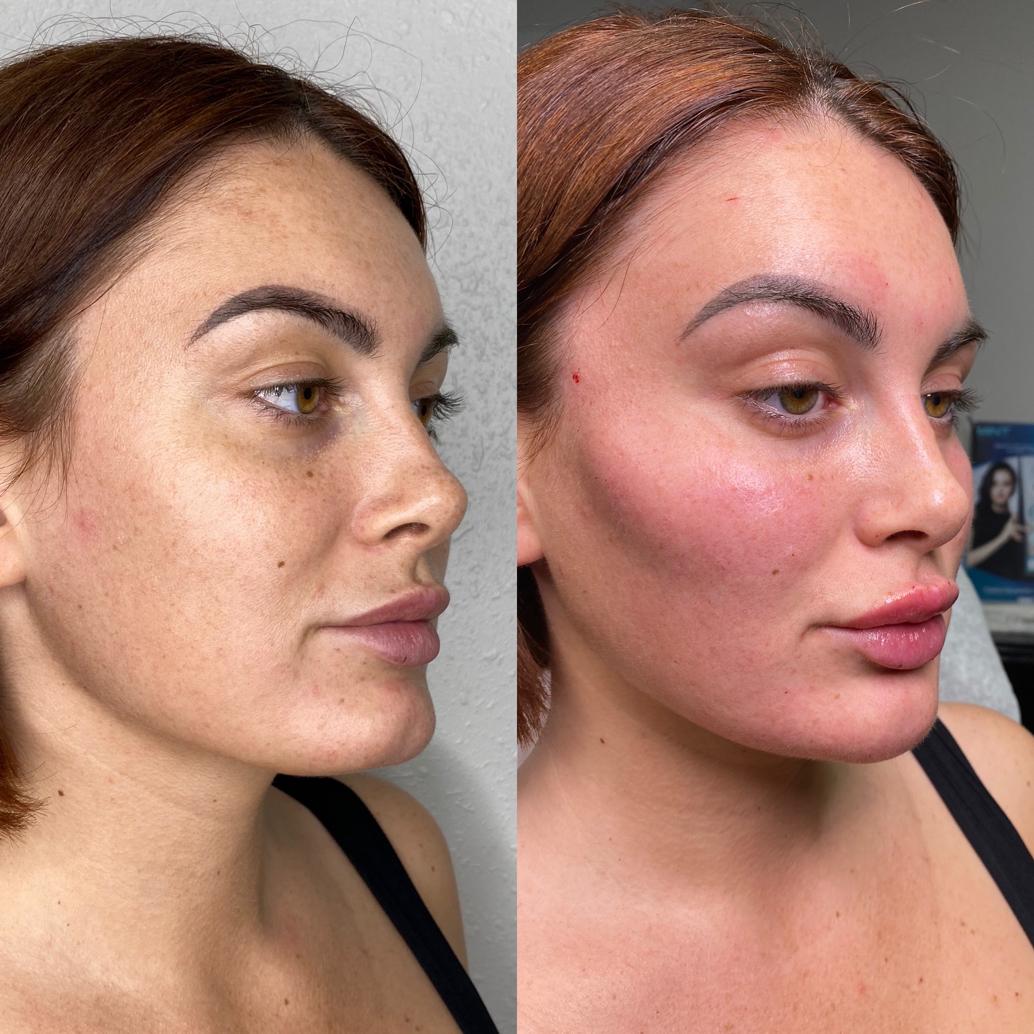 PDO Cheek Lift in Clearwater, FL - Get Youthful Glow Instantly