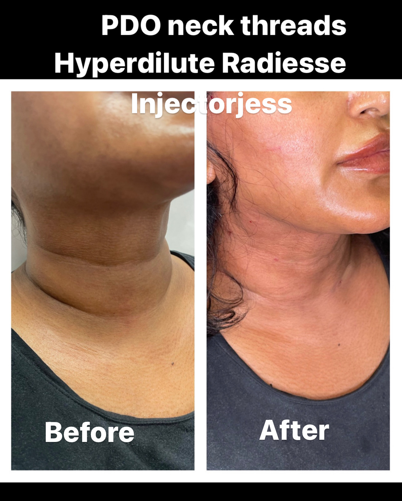 Tech Neck Filler | Lux Injectable