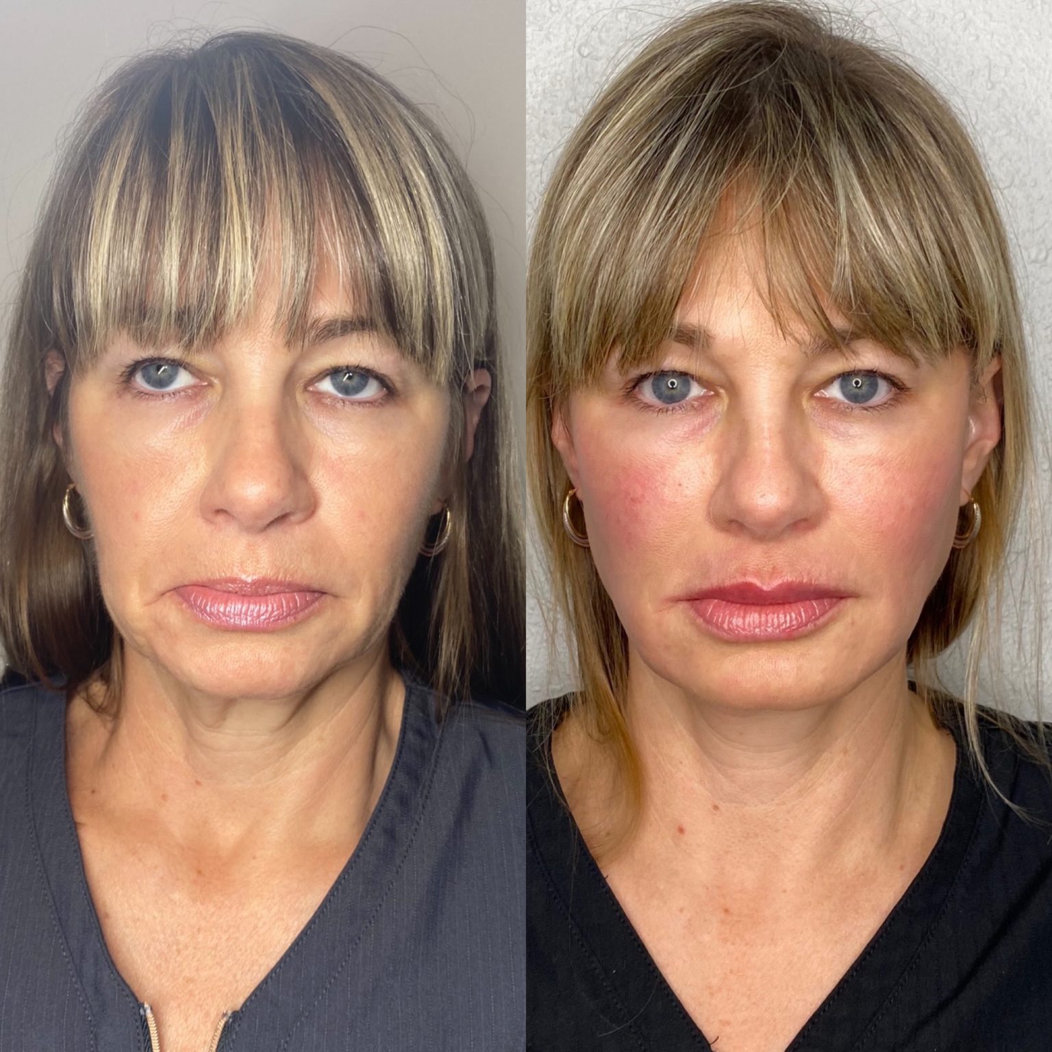 Facial Balancing | Lux Injectable