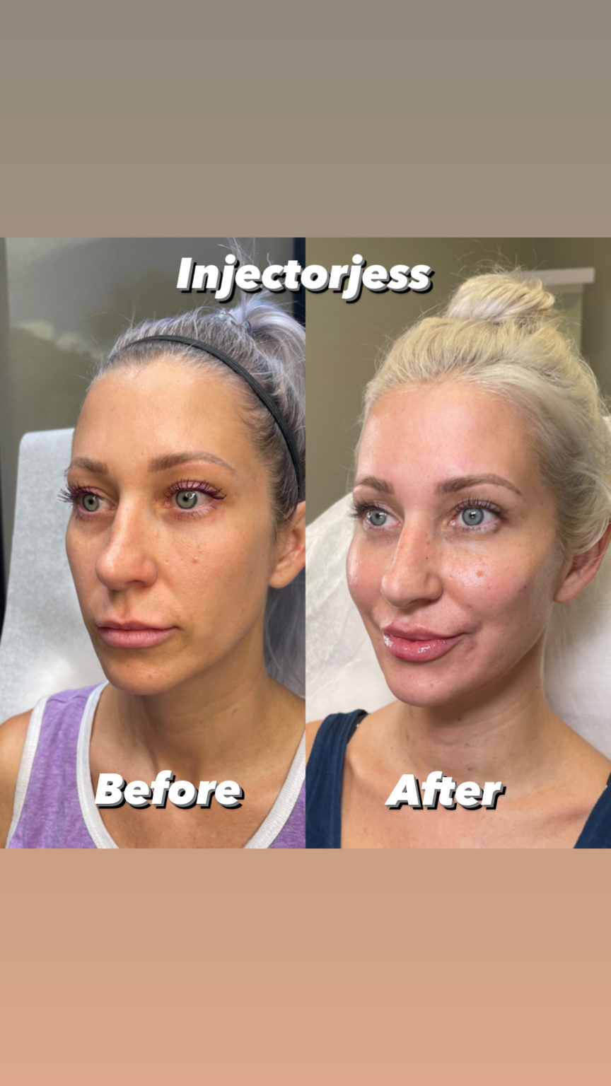 Facial Balancing | Lux Injectable