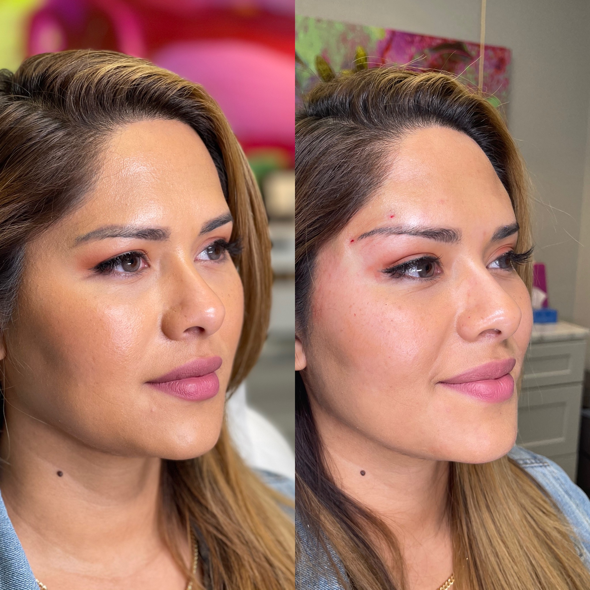 Elevate Your Look: Benefits of Eye Brow Lifts for Confidence | Lux ...