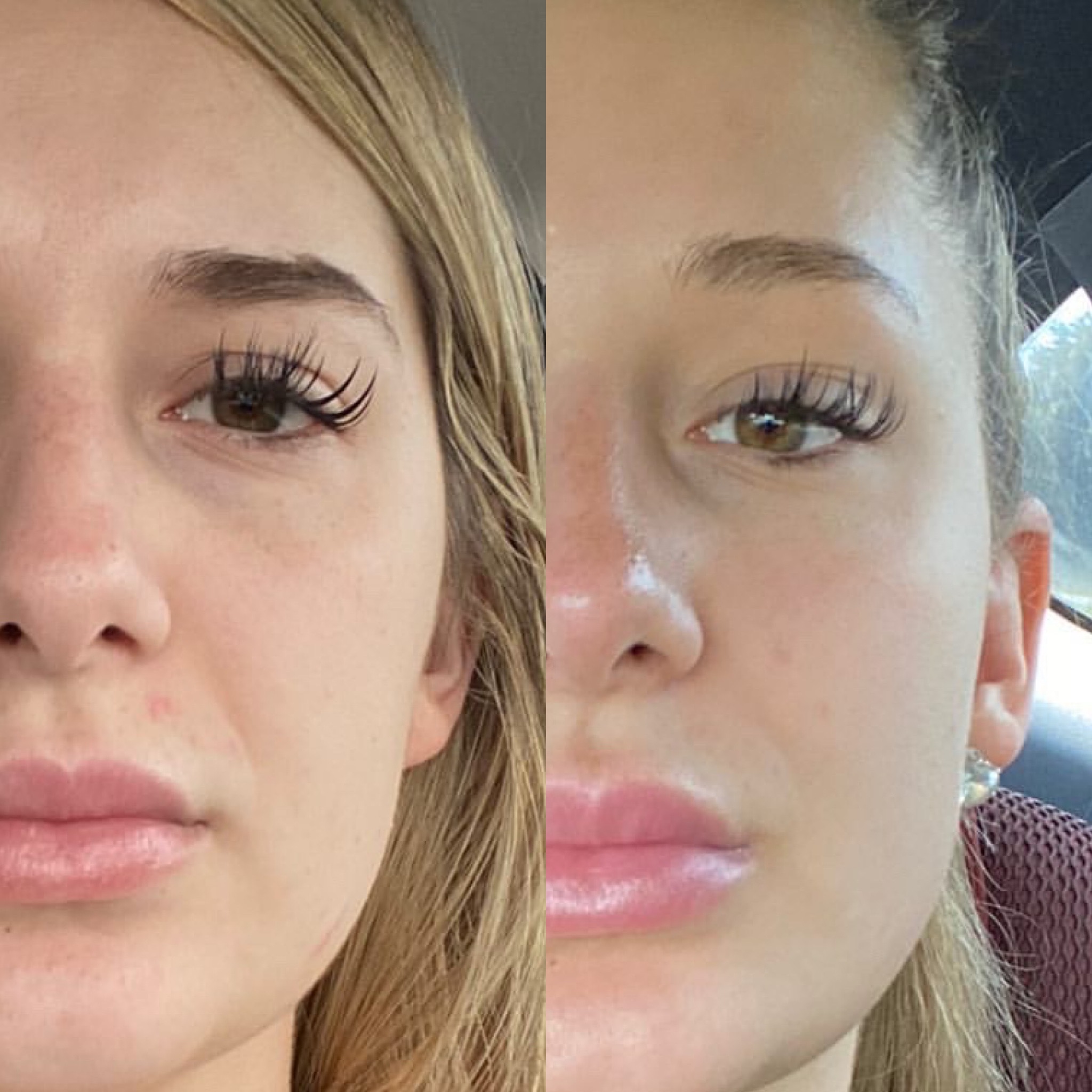 Tear Trough/ Under Eye Filler | Lux Injectable