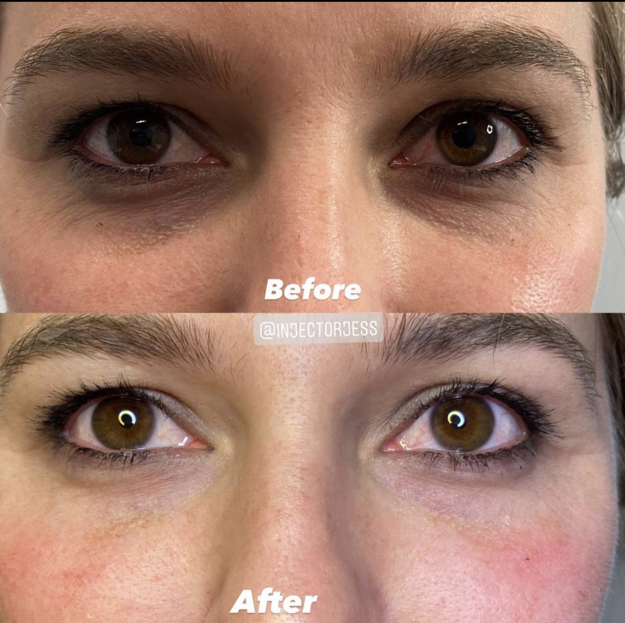 Tear Trough/ Under Eye Filler | Lux Injectable